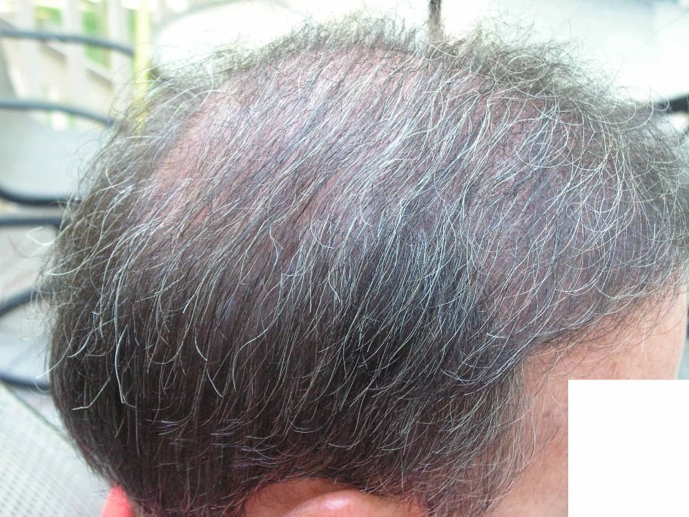 Checkingin ...back after a long absence - Hair Transplant - HairSite ...
