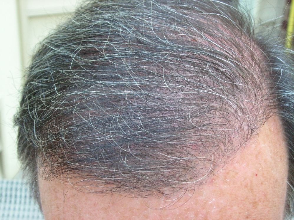 Checkingin ...back after a long absence - Hair Transplant - HairSite ...