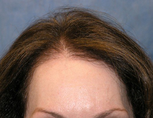 Dr. Robert M. Bernstein / Female Ludwig Class 2 w/Temple Recession ...
