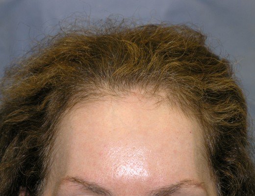 Dr. Robert M. Bernstein / Female Ludwig Class 2 w/Temple Recession ...