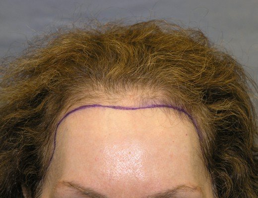 Dr. Robert M. Bernstein / Female Ludwig Class 2 w/Temple Recession ...