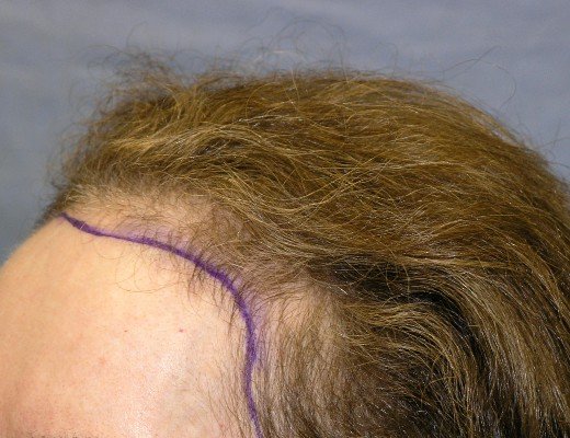 Dr. Robert M. Bernstein / Female Ludwig Class 2 w/Temple Recession ...